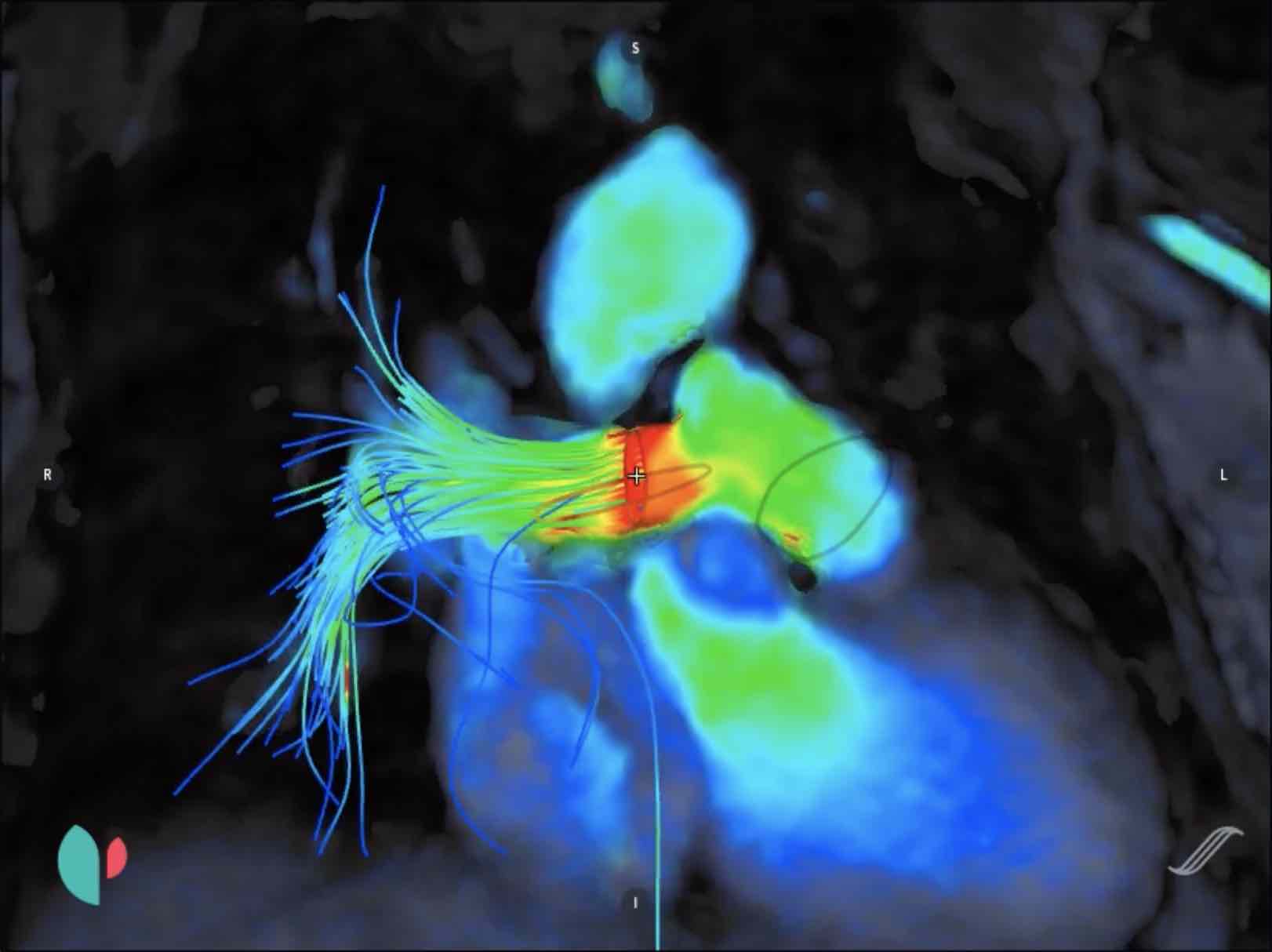 PUBLICADO en RETIC: Cardiorresonancia magnética 4D Flow e insuficiencia ...